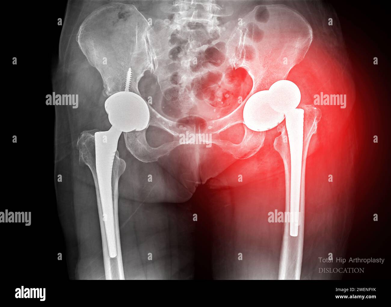 An X-ray reveals both hip joints with prosthetic replacements ...