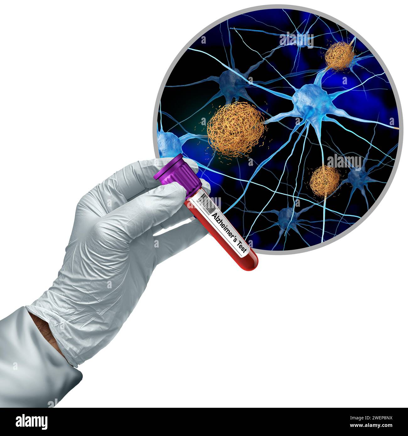 Alzheimers Blood screening Test Diagnostics and Alzheimer Dementia ...