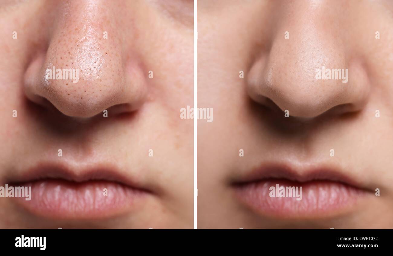 Blackhead treatment, before and after. Collage with photos of woman ...