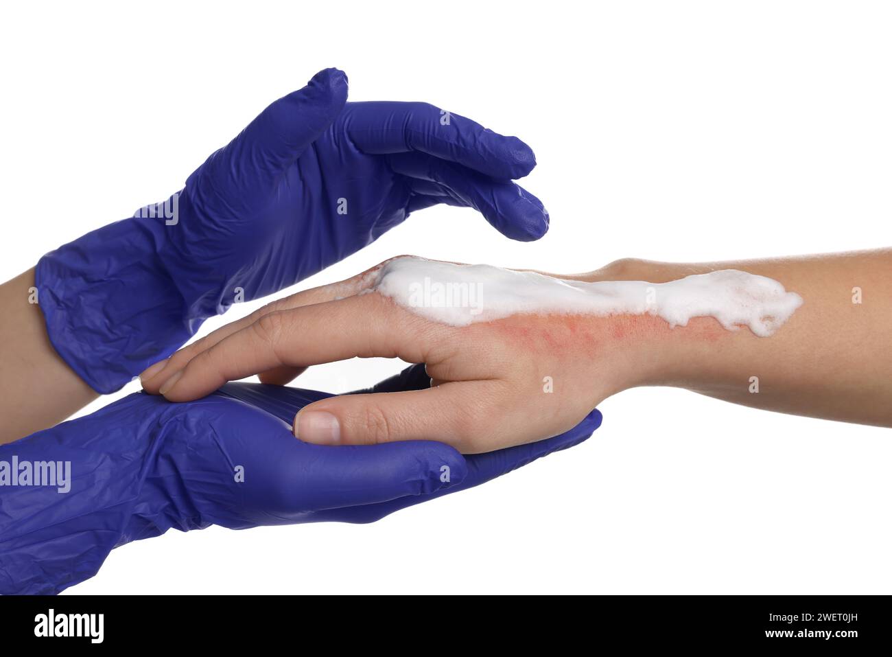 Doctor applying panthenol onto patient's burned hand on white ...