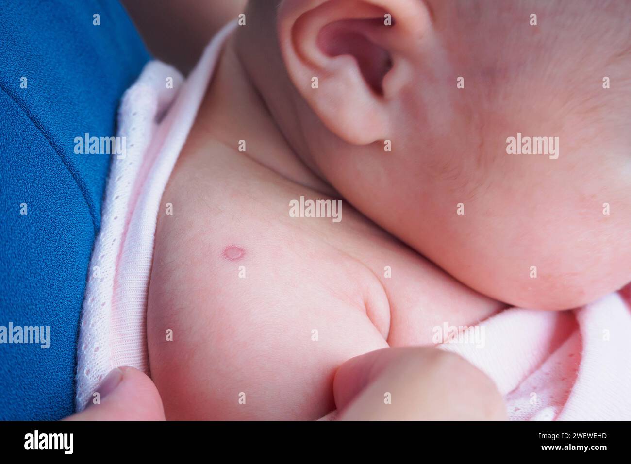 vaccination reaction of Bacillus Calmette Guerin BCG vaccine on newborn ...