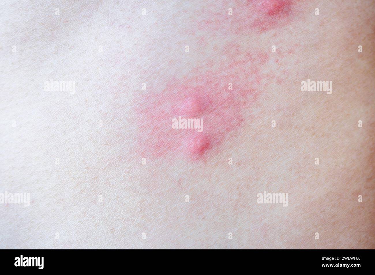 Skin allergy from mosquito bites Stock Photo - Alamy
