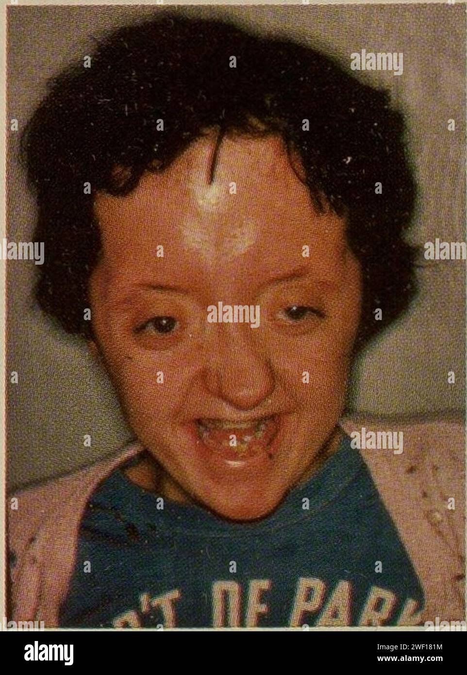 Apert Syndrome 3 Stock Photo - Alamy