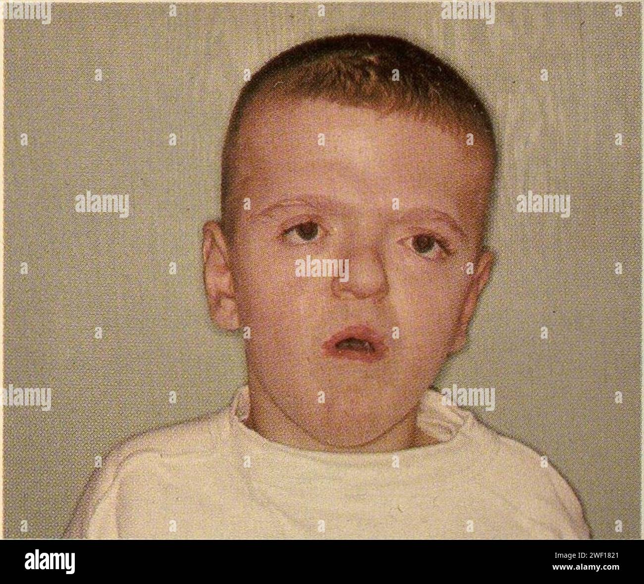 Apert syndrome hi-res stock photography and images - Alamy