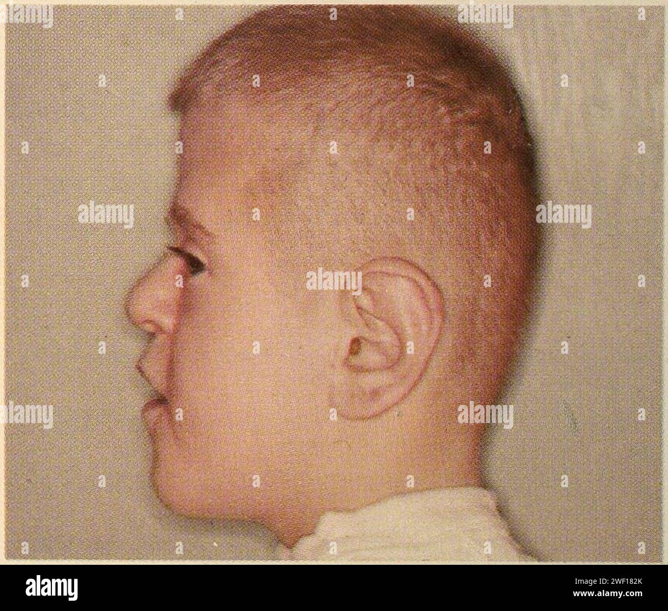 Apert Syndrome 5 Stock Photo - Alamy