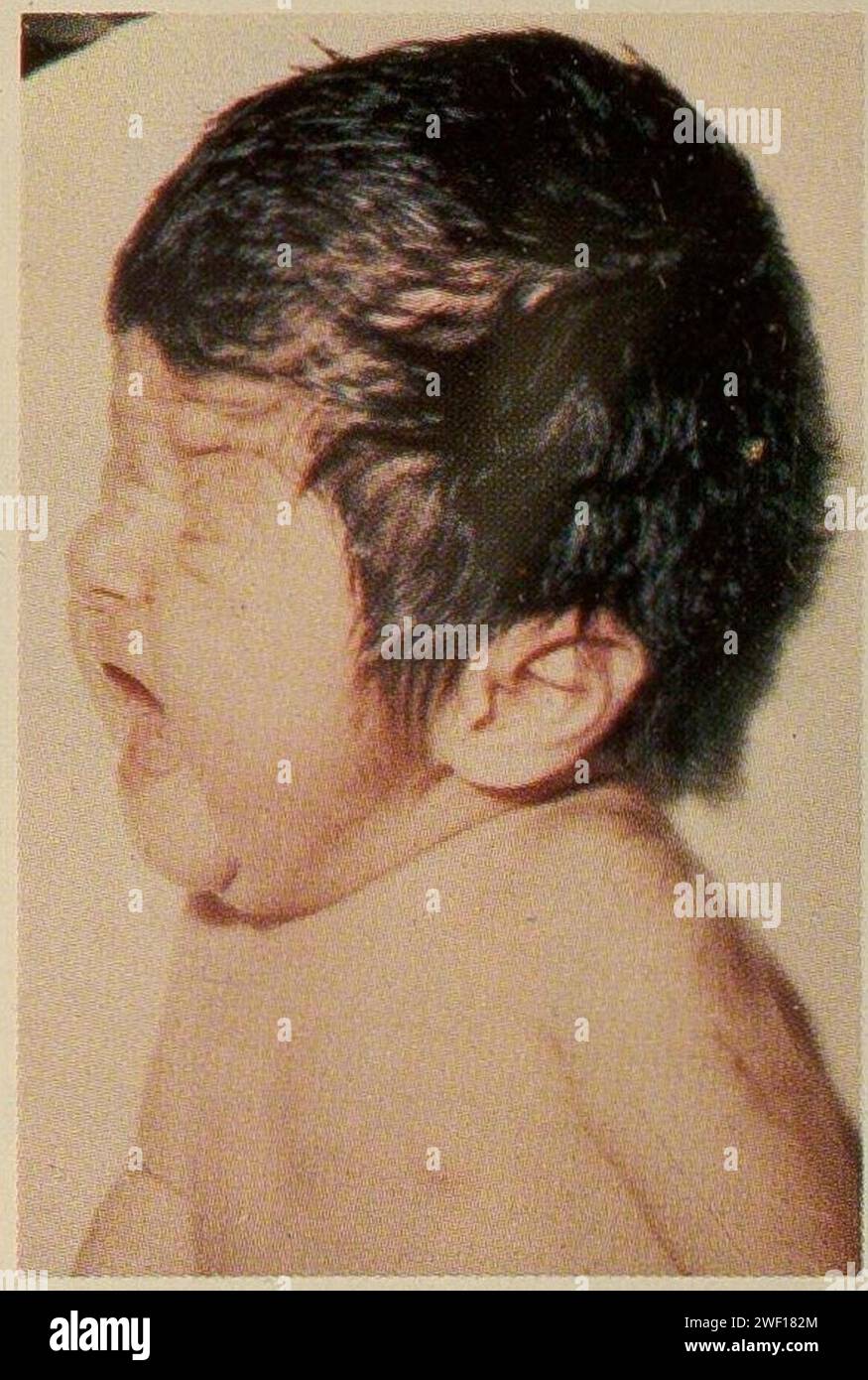 Apert syndrome hi-res stock photography and images - Alamy