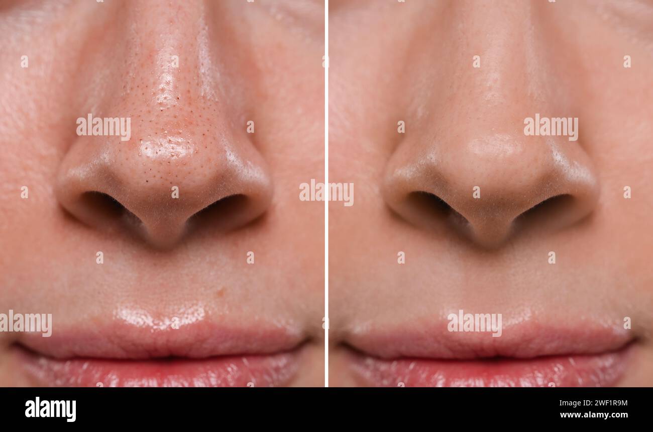 Blackhead treatment, before and after. Collage with photos of woman ...