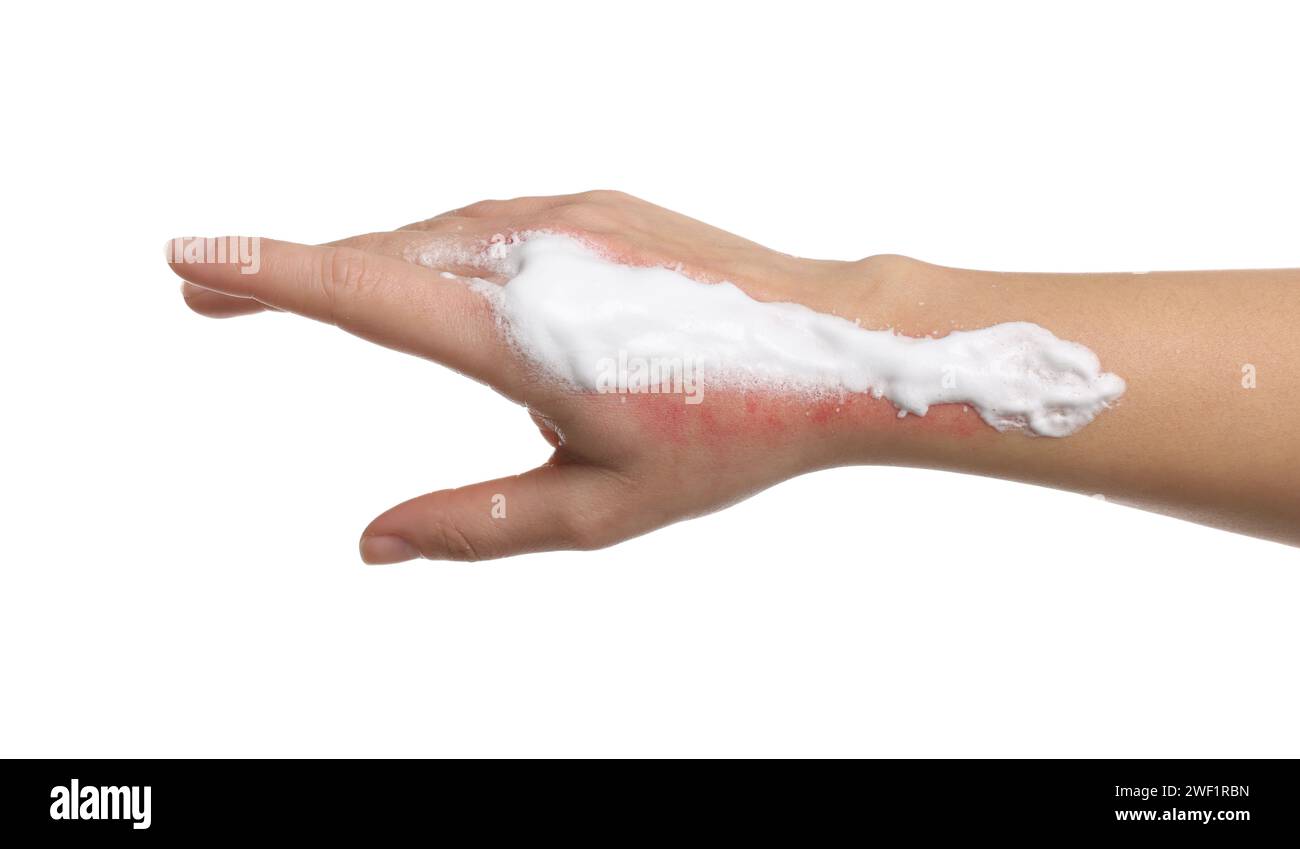 Woman with panthenol on her burned hand against white background ...