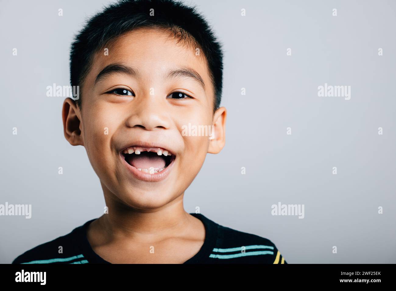 Boy smiling wide showing gap from lost upper tooth. Child dental ...