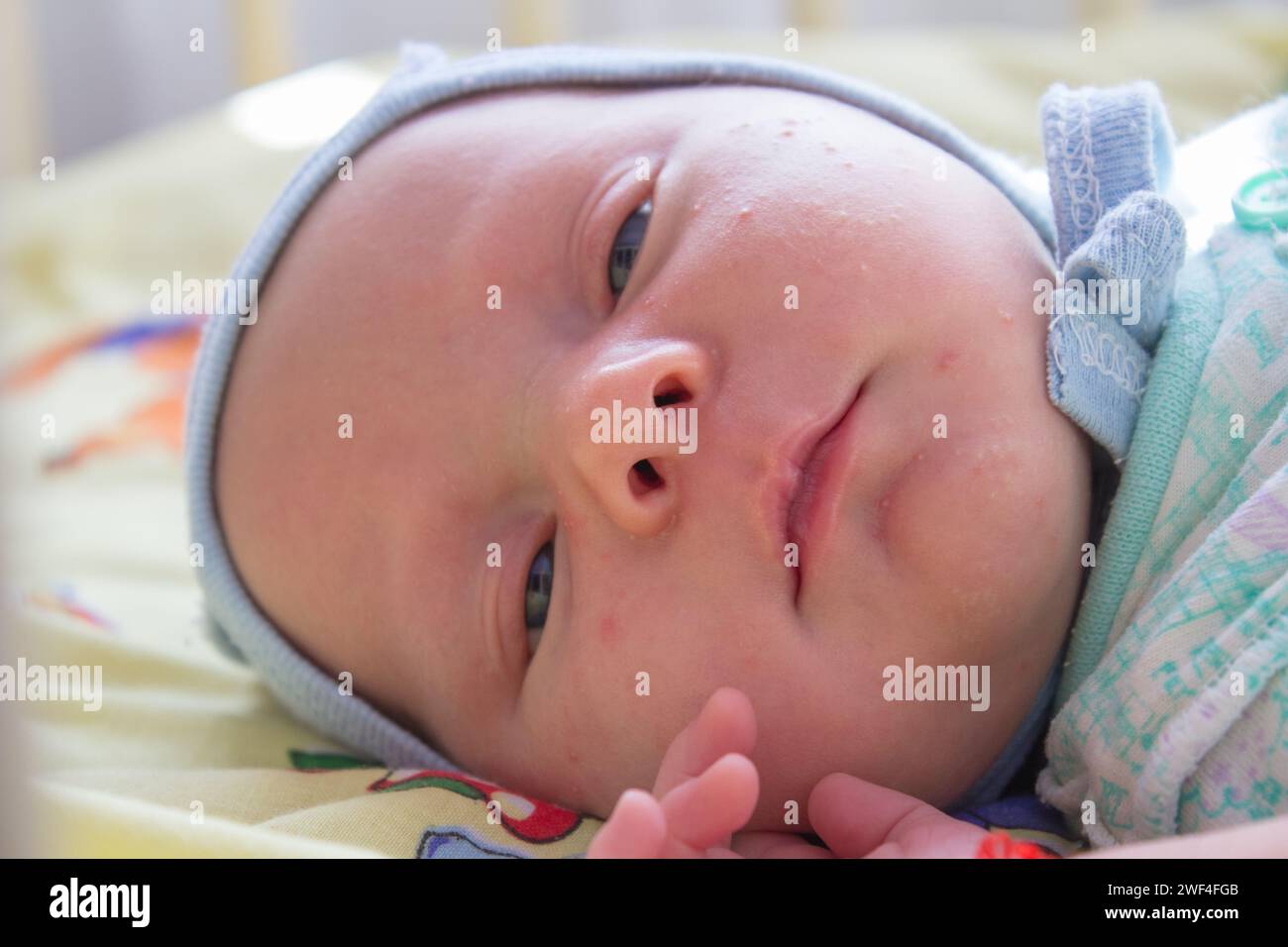 newborn infant with acne on face Stock Photo - Alamy