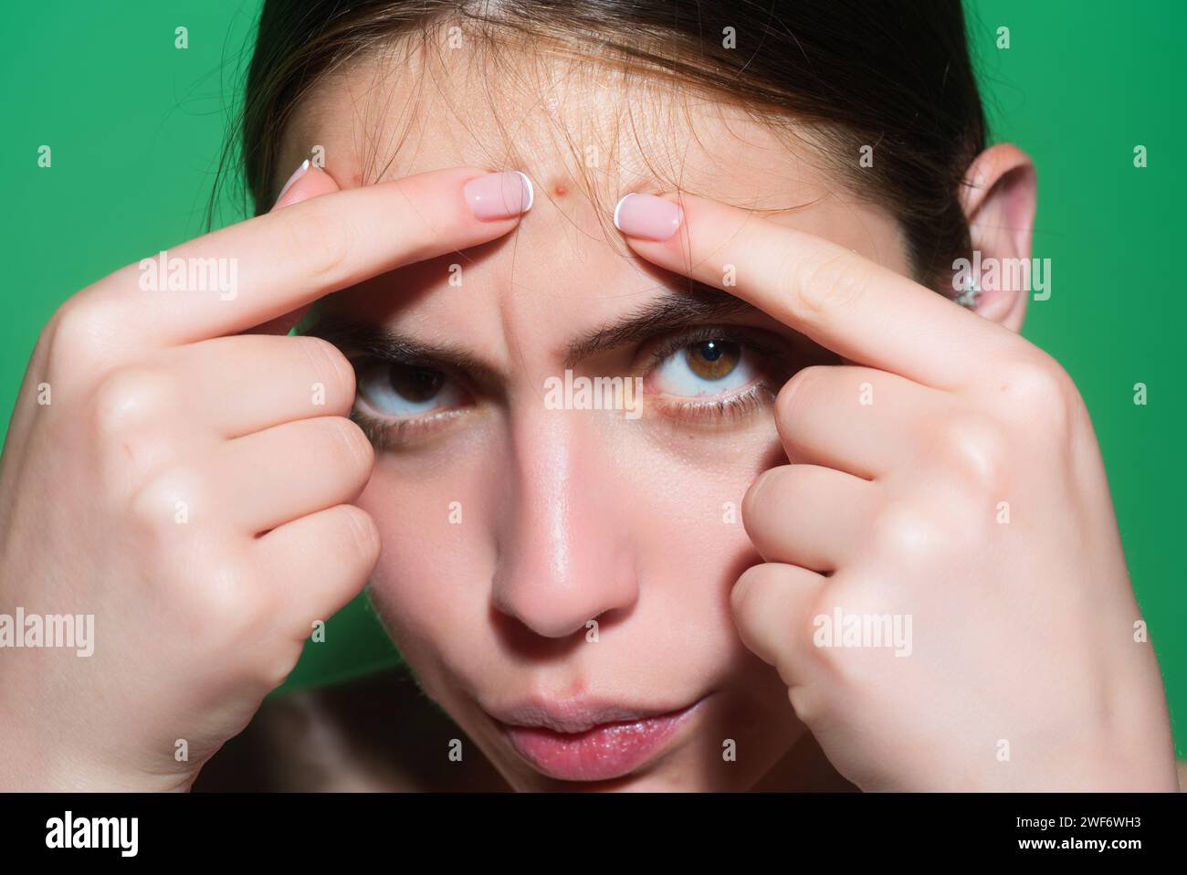 Pustule acne. Close up pimple on female skin. Dermatology, puberty ...