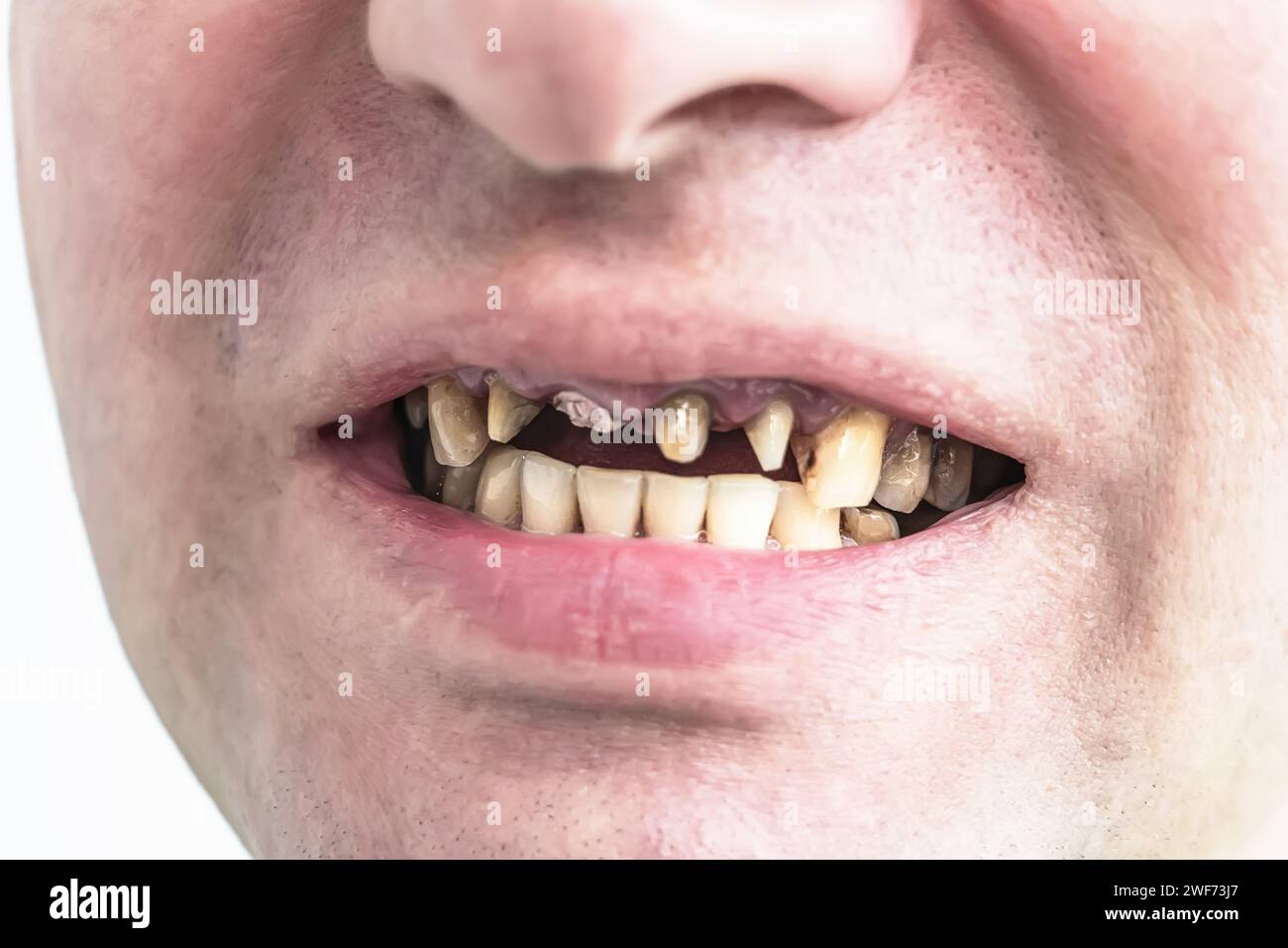 Periodontal disease, loose teeth in toothless man mouth, close up ...