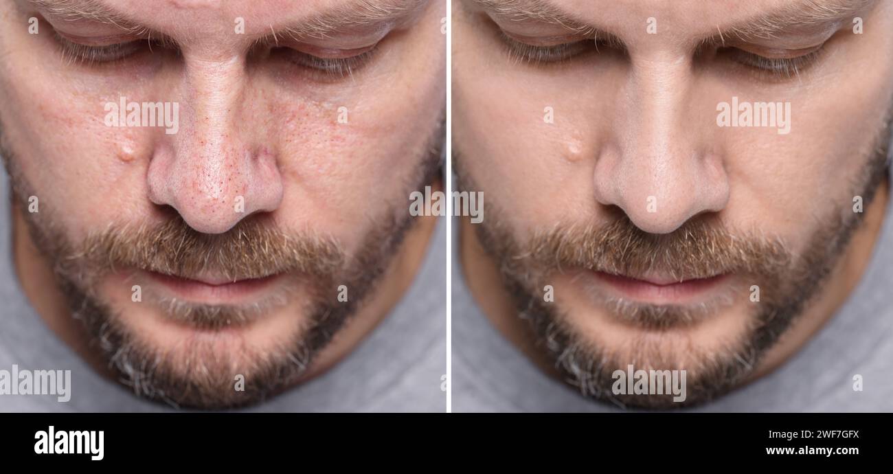 Blackhead treatment, before and after. Collage with photos of man ...