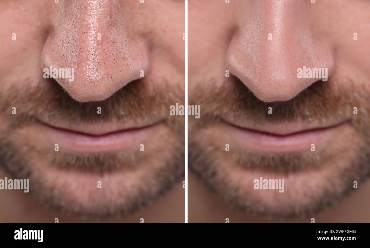 Blackhead treatment, before and after. Collage with photos of man ...