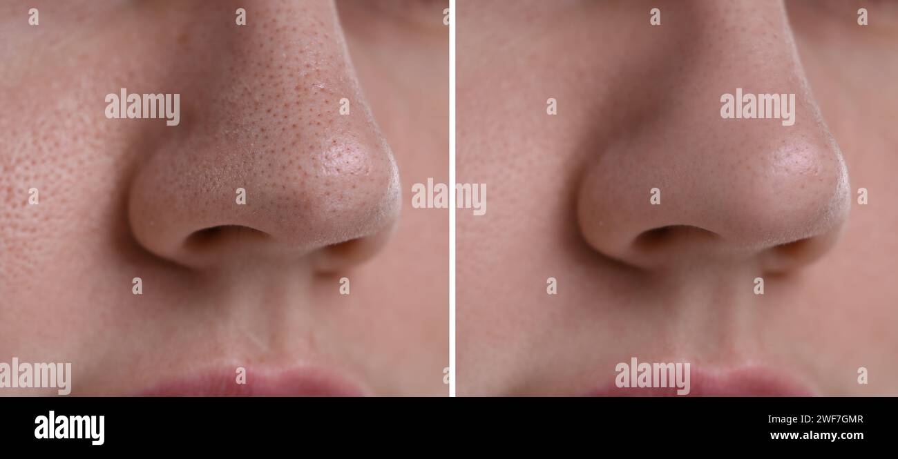 Blackhead treatment, before and after. Collage with photos of woman ...