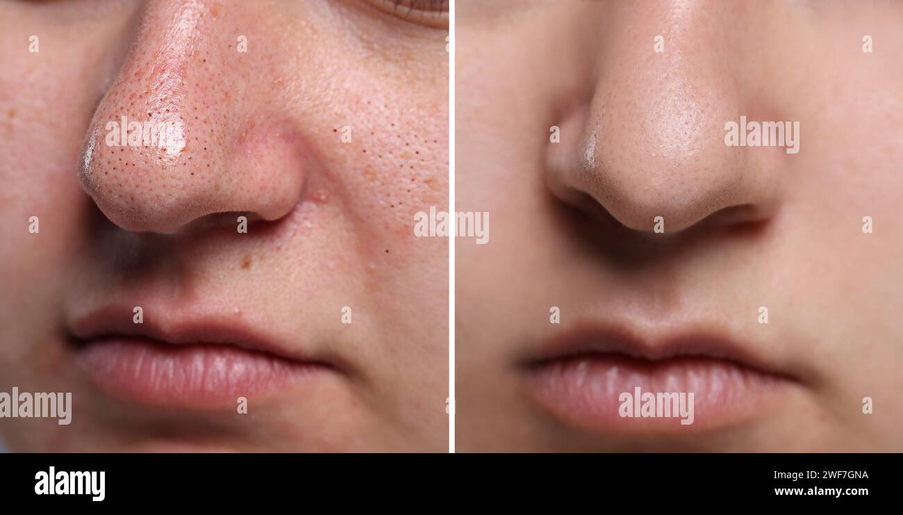 Blackhead treatment, before and after. Collage with photos of woman ...