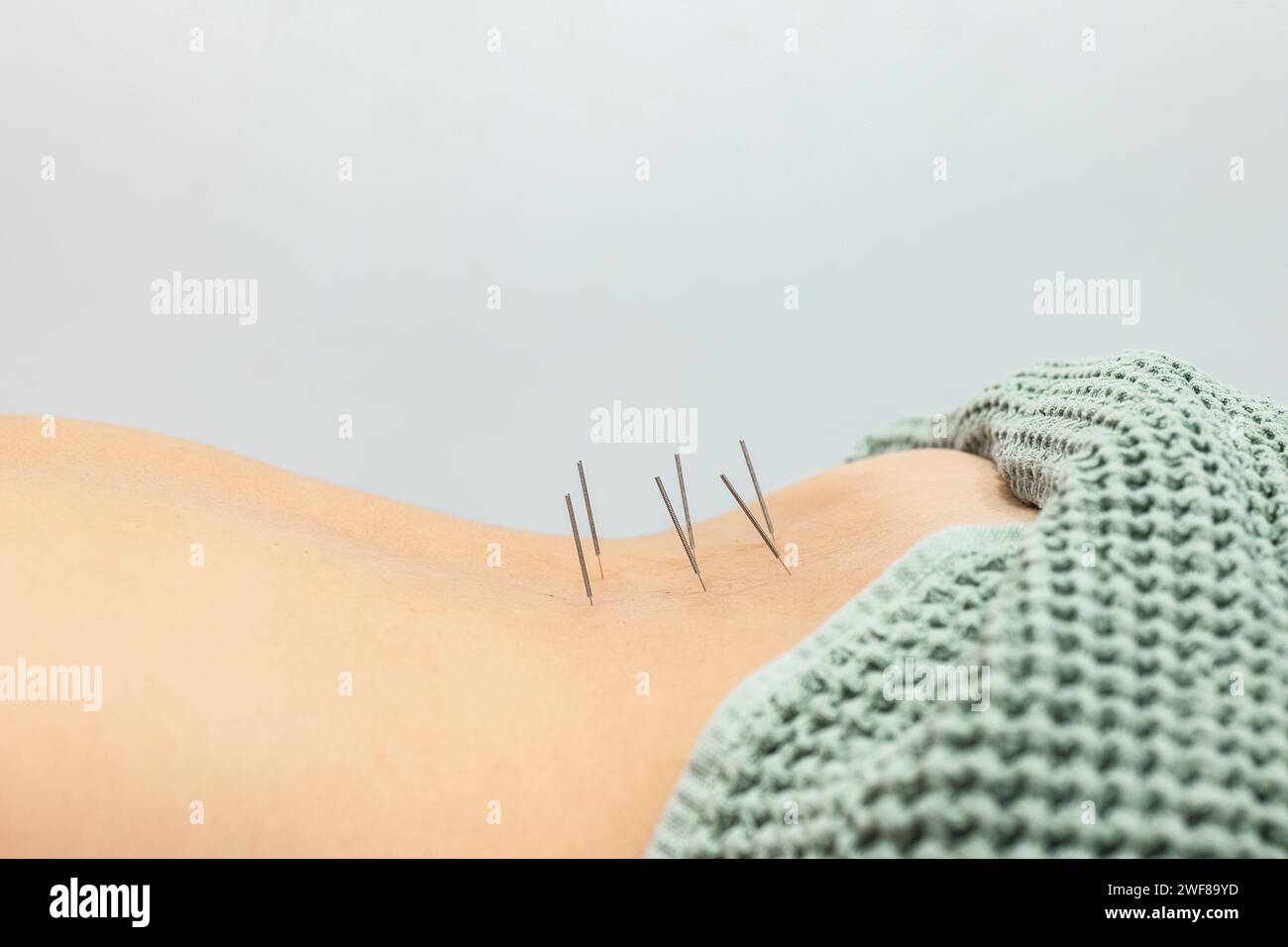 A detailed close-up of several acupuncture needles inserted into a ...