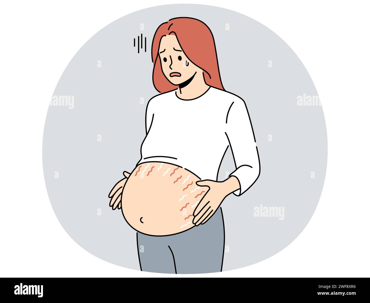 Tired pregnant woman with huge belly with stretch marks on last months ...