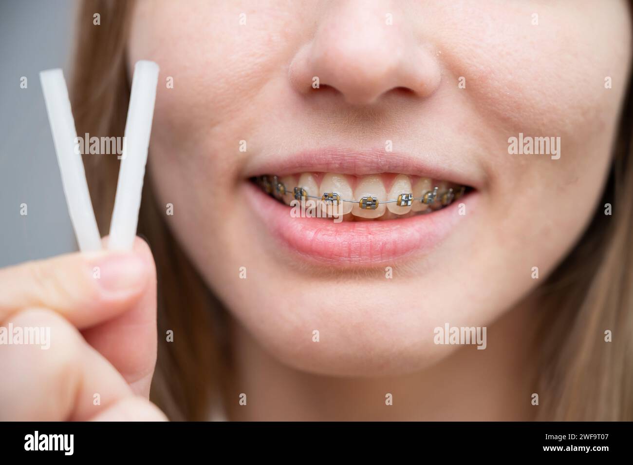 Close-up portrait of a woman with braces using special orthodontic wax ...