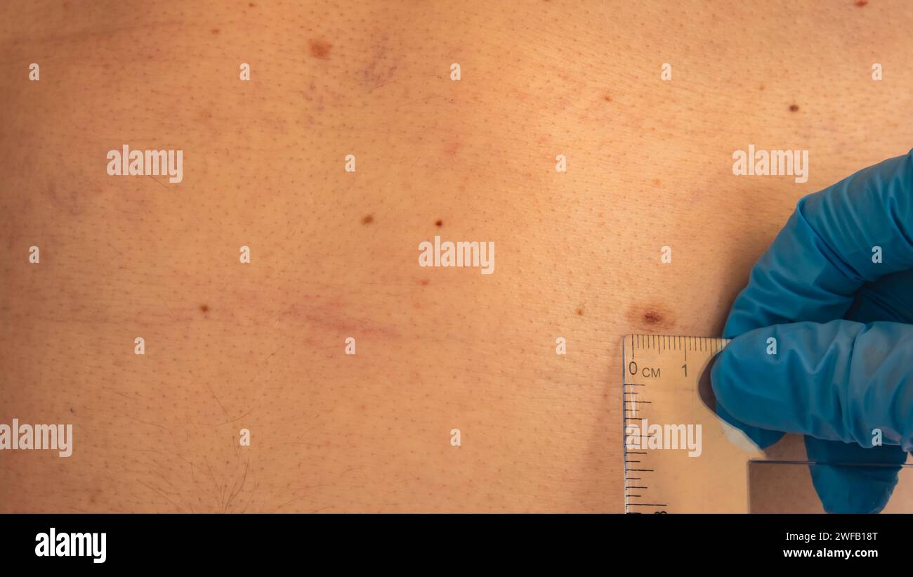 Dermatologist checking sizes of male birthmarks with ruler. Doctor ...