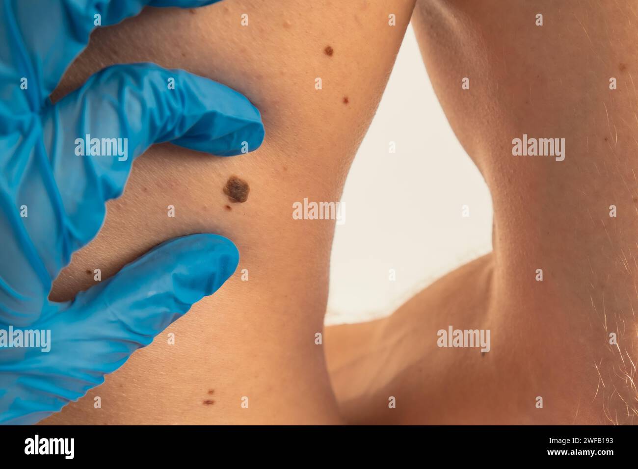Dermatologist checking male birthmarks for changing size. Annual ...