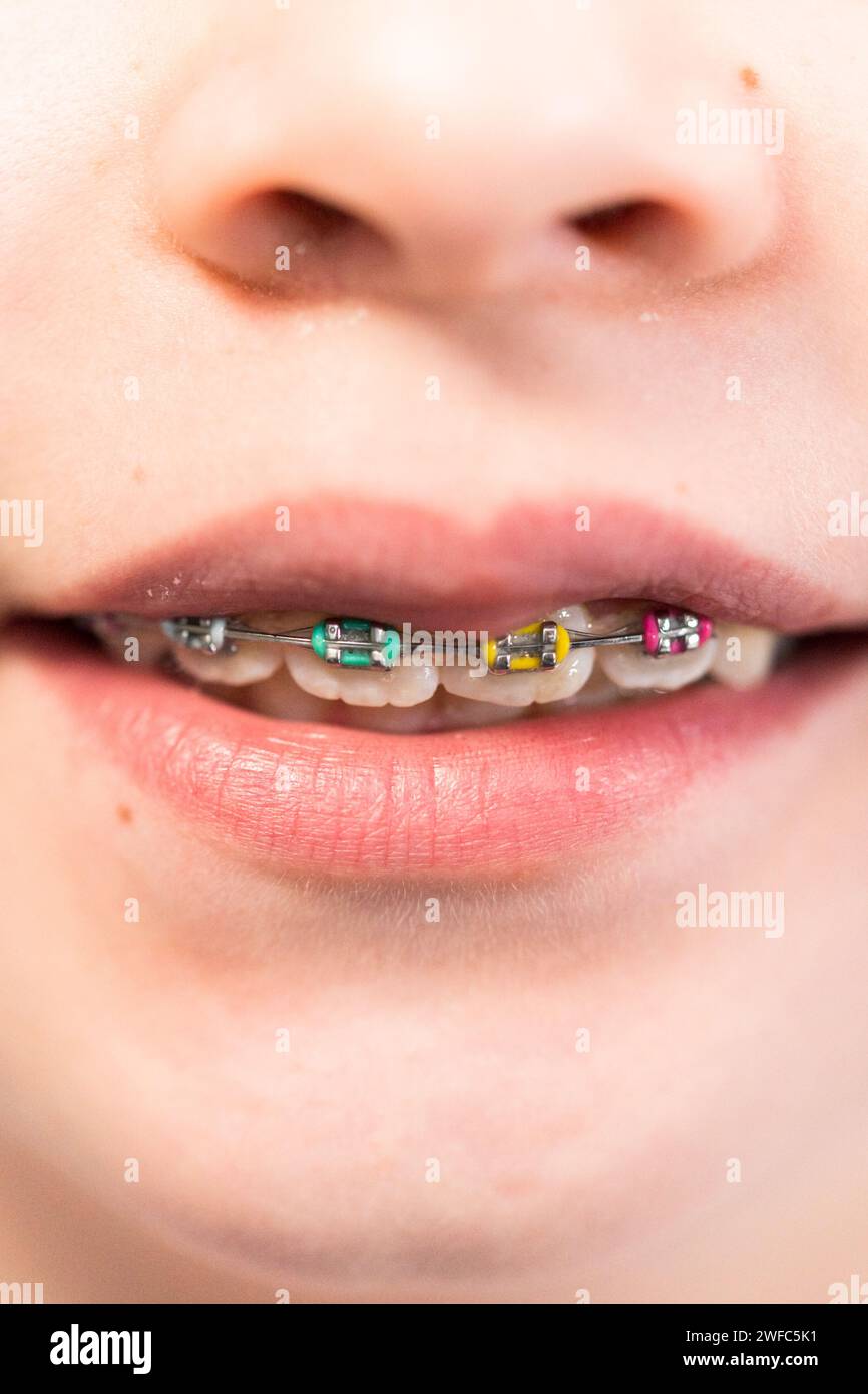 Little girl with rainbow braces Stock Photo - Alamy