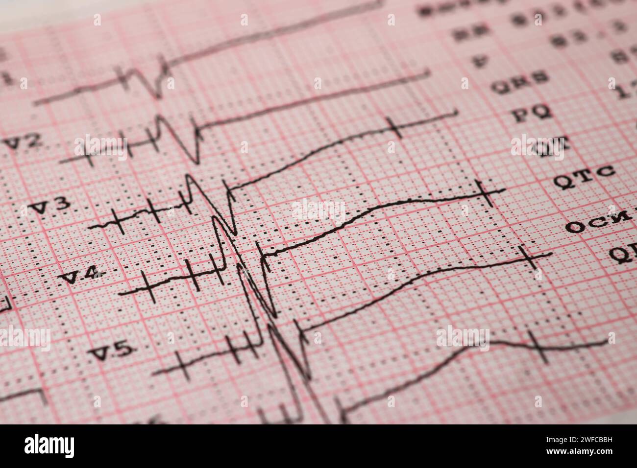 heart rhythm ekg note on paper Doctors use it to analyze heart disease ... heart rhythm ekg note on paper Doctors use it to analyze heart disease ...