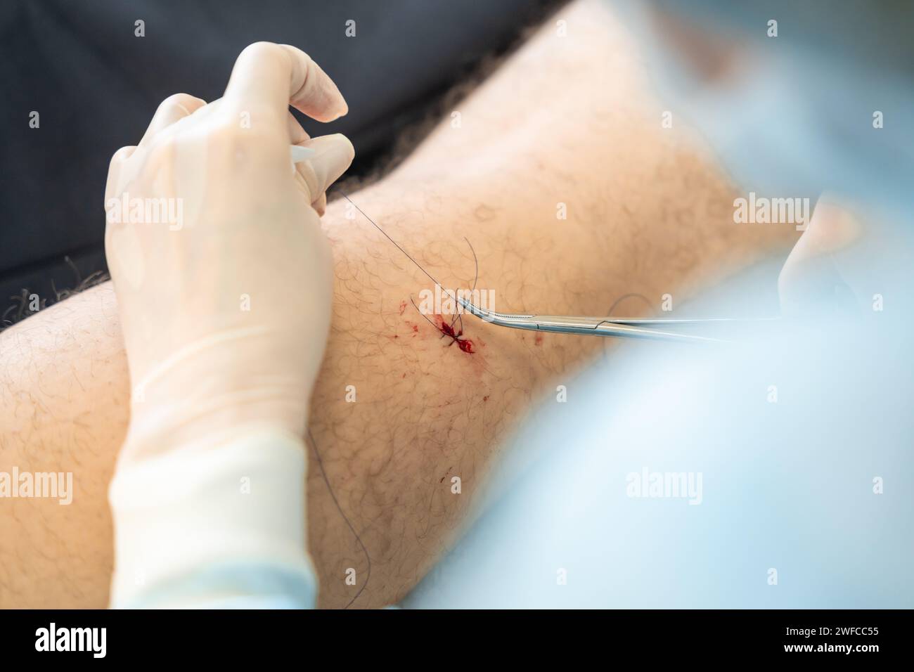 Dermatologist surgeon stitching up a wound after surgery, close up view ...