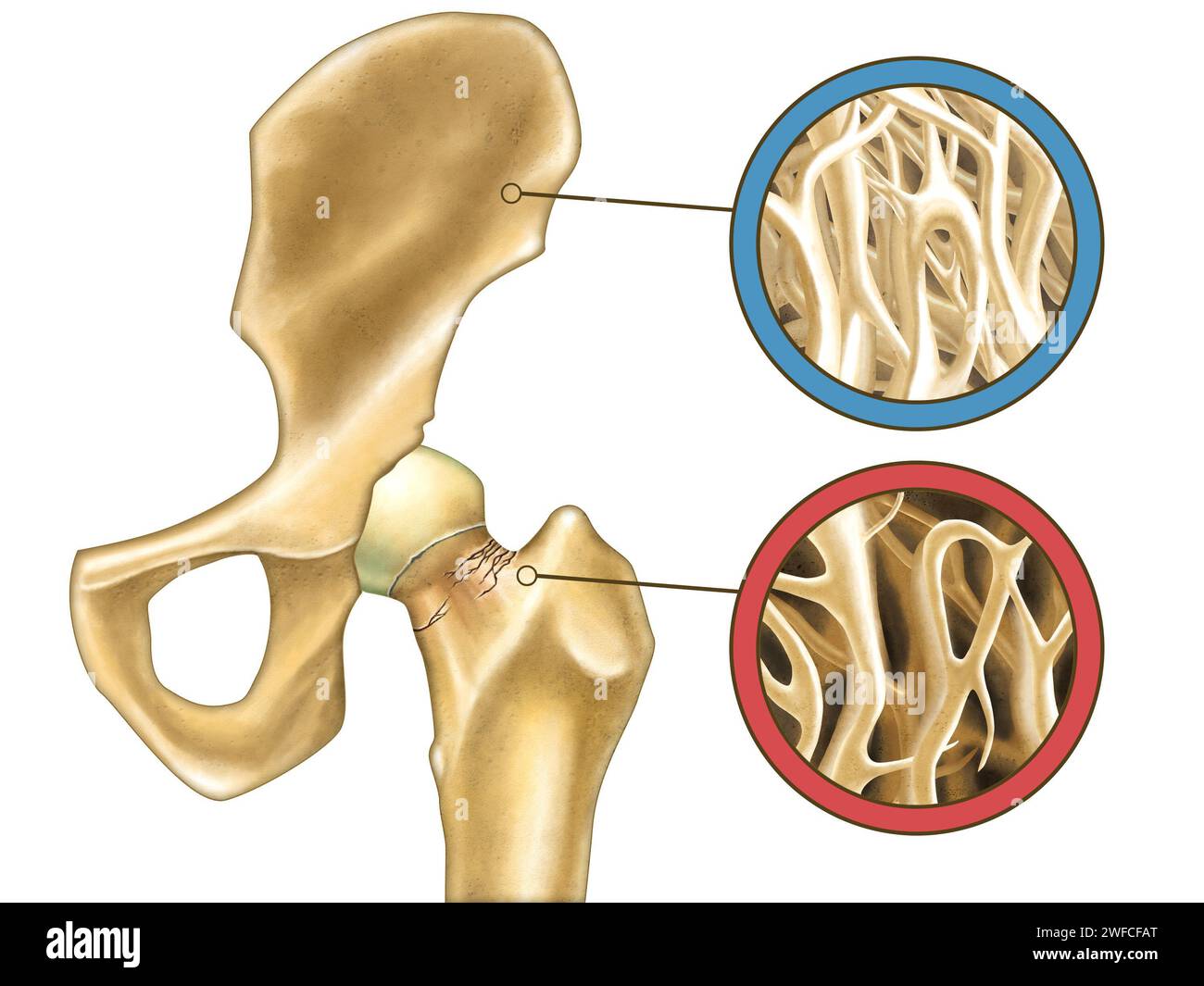 Skeleton close-up showing normal bone and osteoporosis. Digital ...