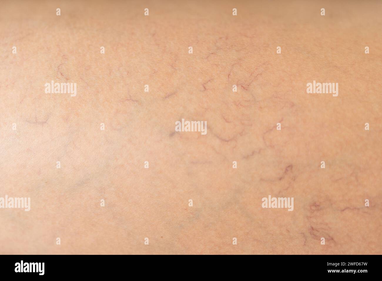 Varicose veins of small vessels on the skin of a woman's thigh Stock ...