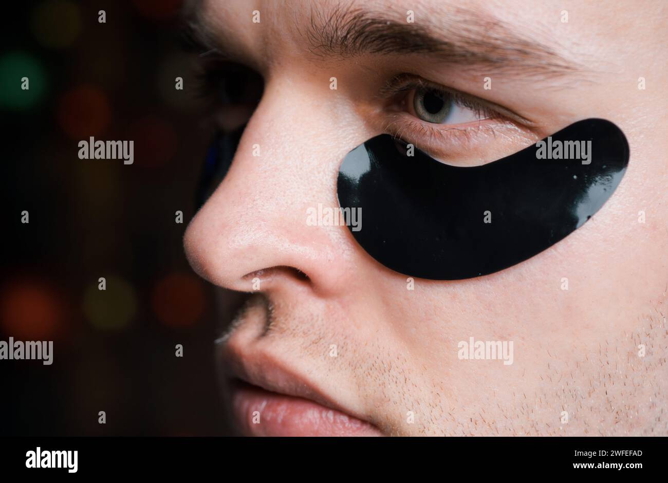 Man face with flakes under the eyes. Mans flakes. Patches under close ...