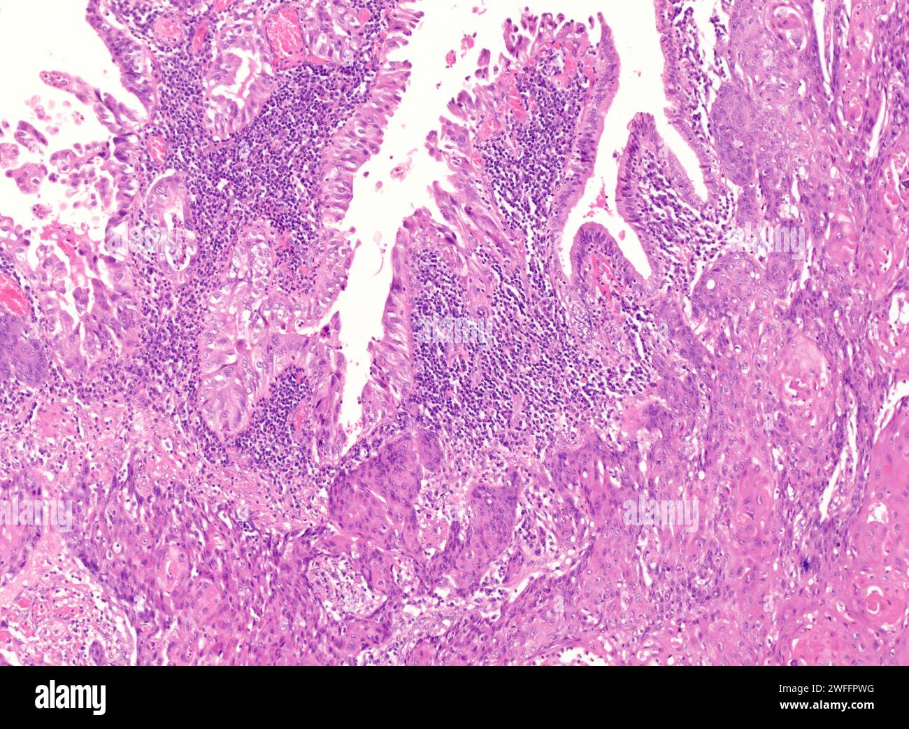 Gallbladder cancer, light micrograph Stock Photo - Alamy