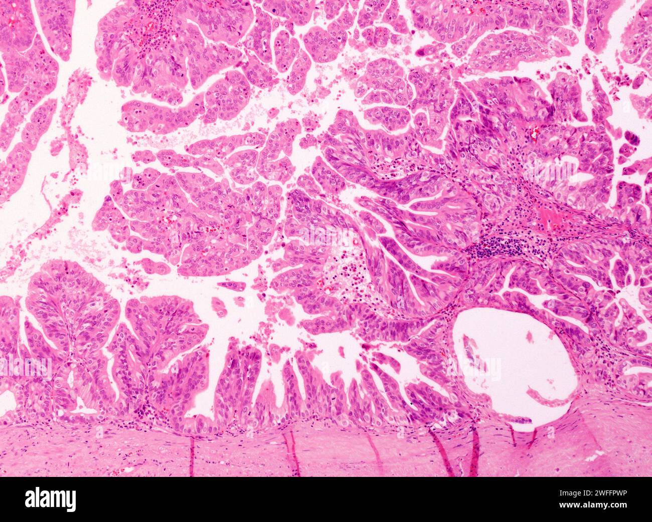 Intracholecystic papillary neoplasm, light micrograph Stock Photo - Alamy