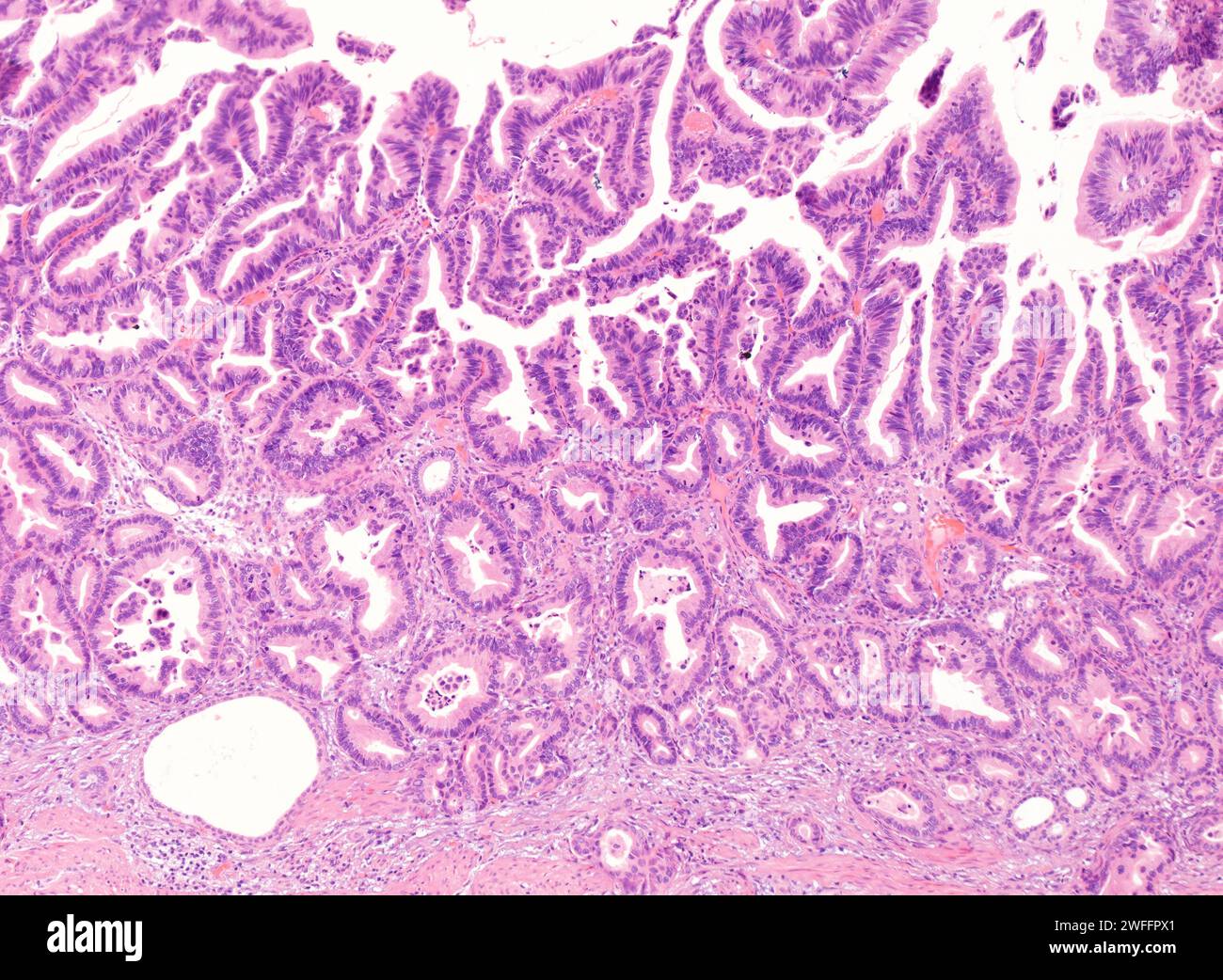 Gallbladder cancer, light micrograph Stock Photo - Alamy