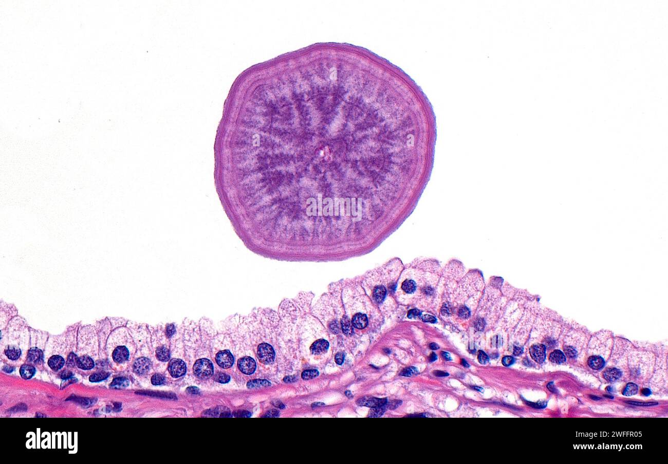 Corpus amylaceous and prostate gland cells, light micrograph Stock ...