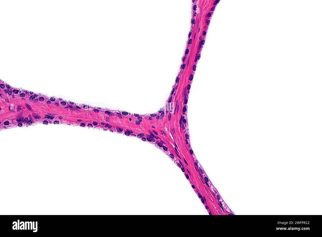 Prostate cystic atrophy, light micrograph Stock Photo - Alamy