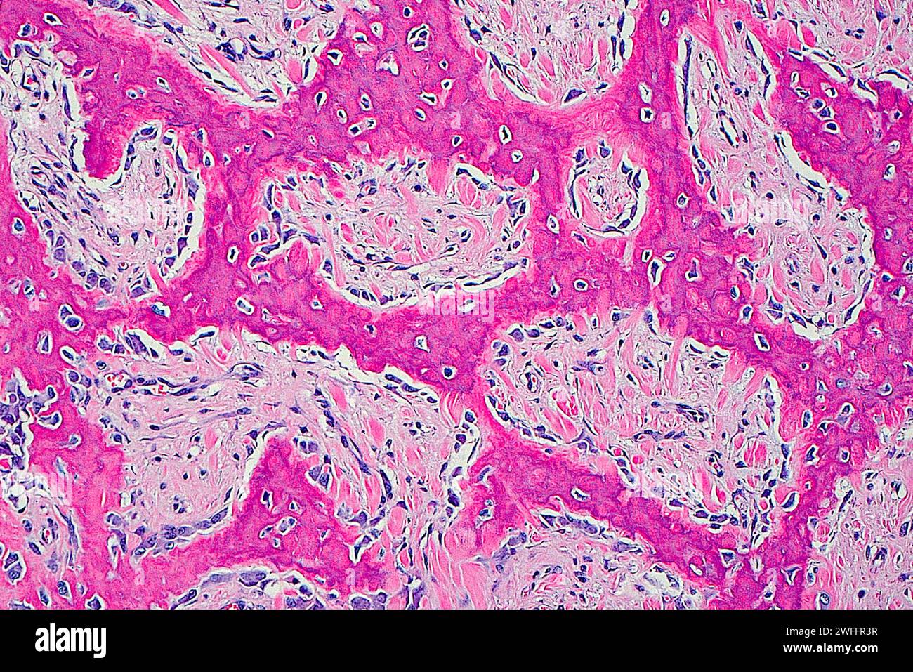 Woven bone, light micrograph Stock Photo - Alamy