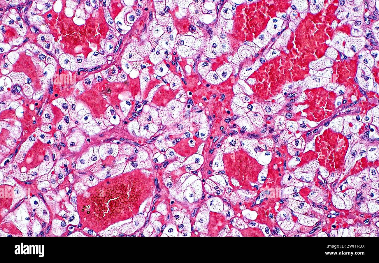 Clear cell kidney cancer, light micrograph Stock Photo - Alamy
