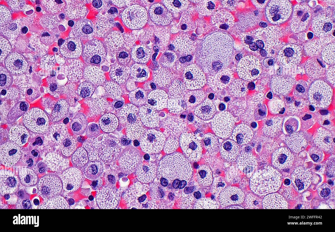 Foamy histiocytes, light micrograph Stock Photo - Alamy