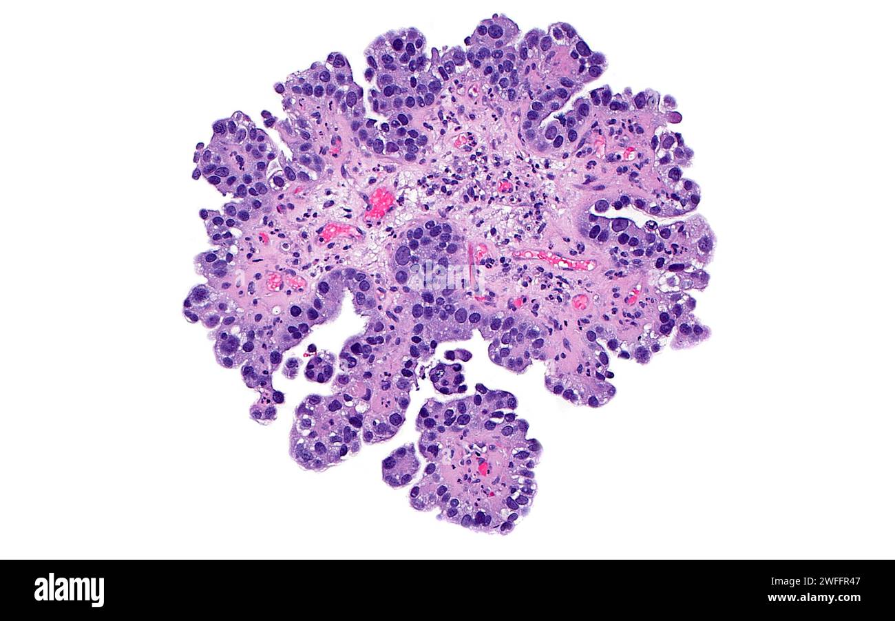 Endometrial clear cell adenocarcinoma, light micrograph Stock Photo - Alamy