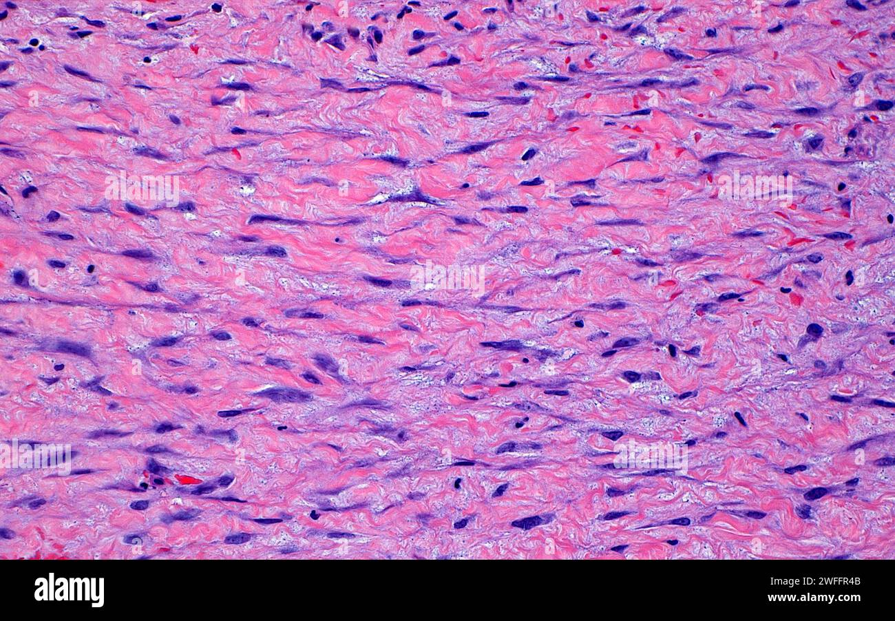 Reactive fibroblast cells, light micrograph Stock Photo - Alamy