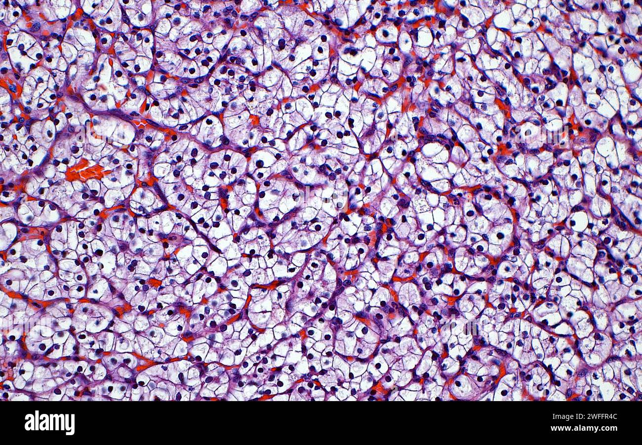Clear cell kidney cancer, light micrograph Stock Photo - Alamy