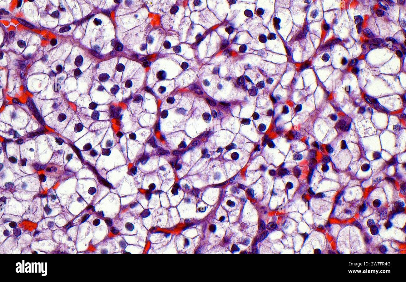 Clear cell kidney cancer, light micrograph Stock Photo - Alamy