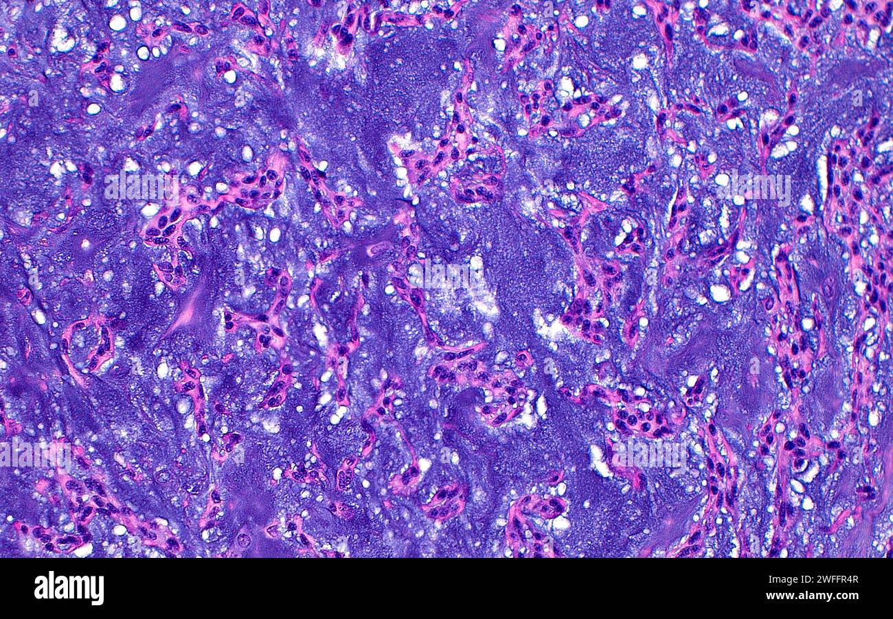 Pleomorphic adenoma, light micrograph Stock Photo - Alamy