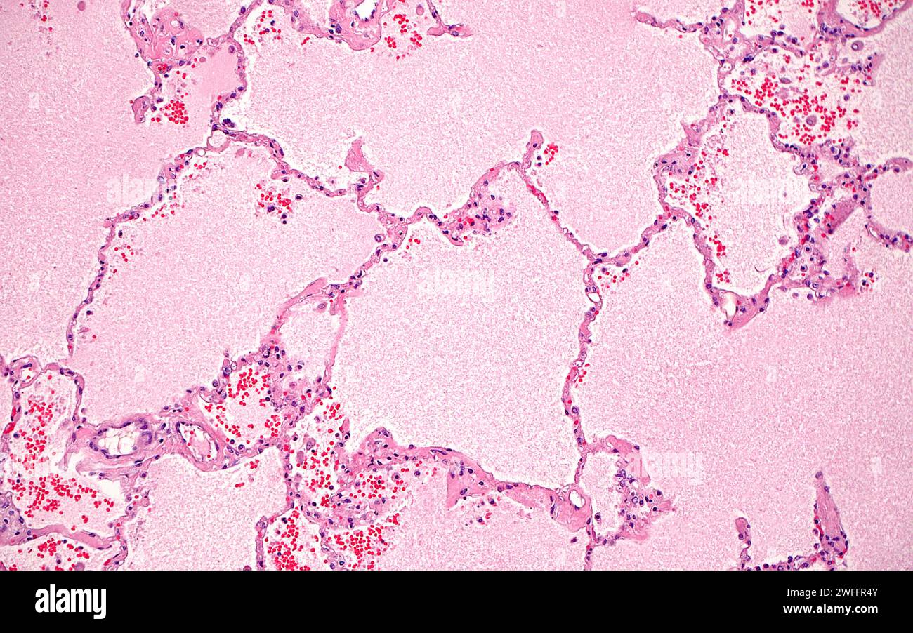 Pulmonary oedema, light micrograph Stock Photo - Alamy