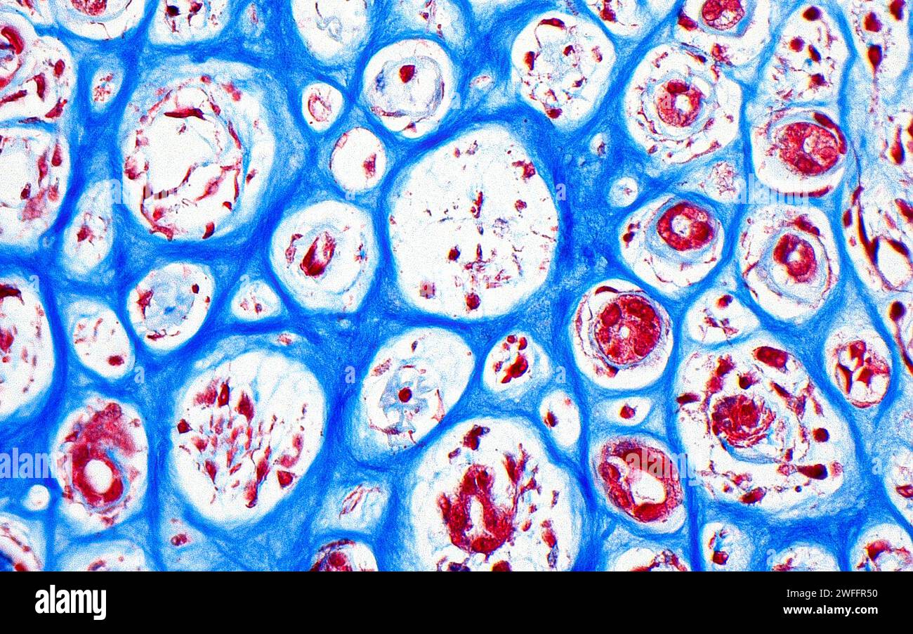 Kidney fibrosis, light micrograph Stock Photo - Alamy