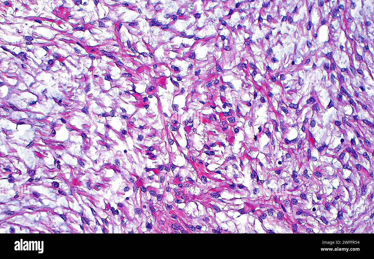 Prostatic stromal nodule, light micrograph Stock Photo - Alamy