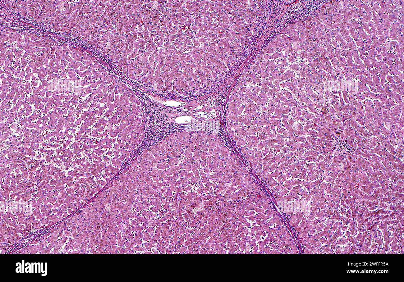 Liver cirrhosis, light micrograph Stock Photo - Alamy