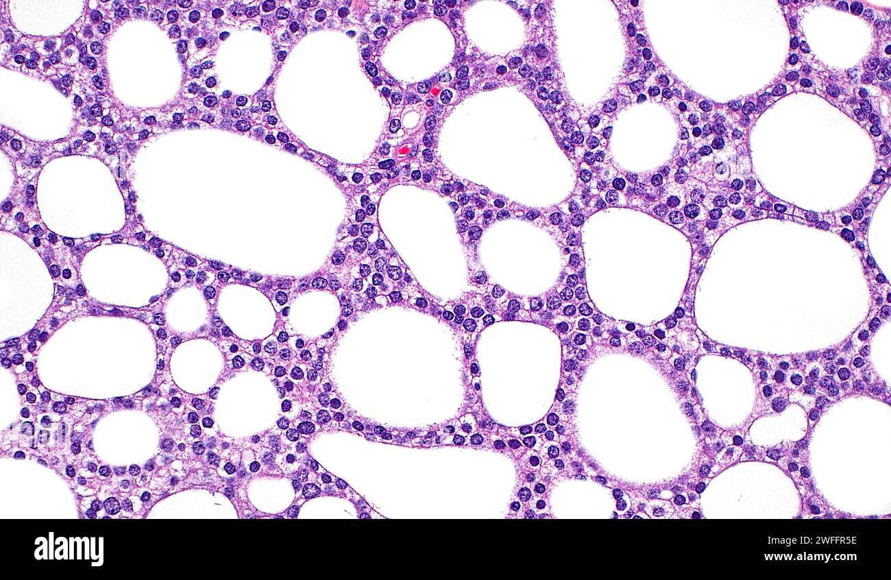 Prostate cancer cribriform pattern, light micrograph Stock Photo - Alamy