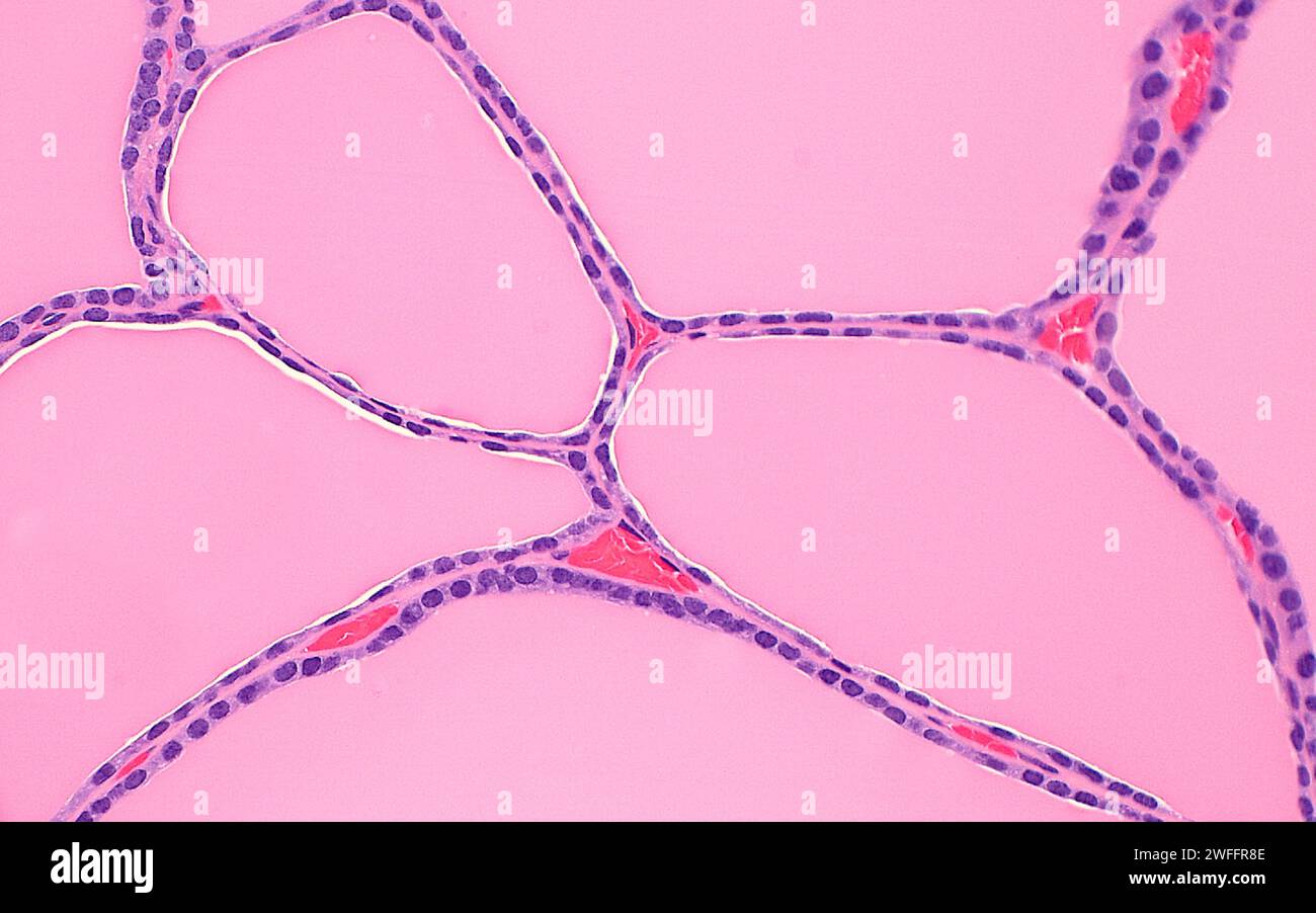 Thyroid goitre, light micrograph Stock Photo - Alamy